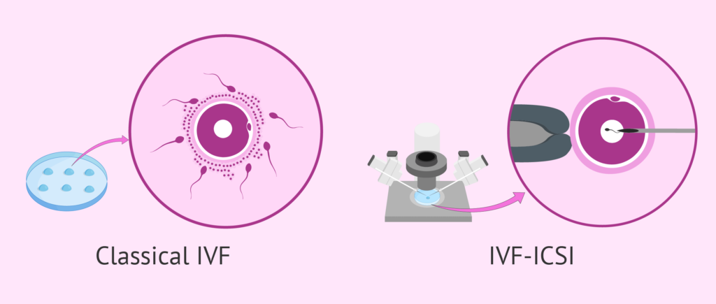 Understanding the Differences Between IVF and ICSI | Aurawomen