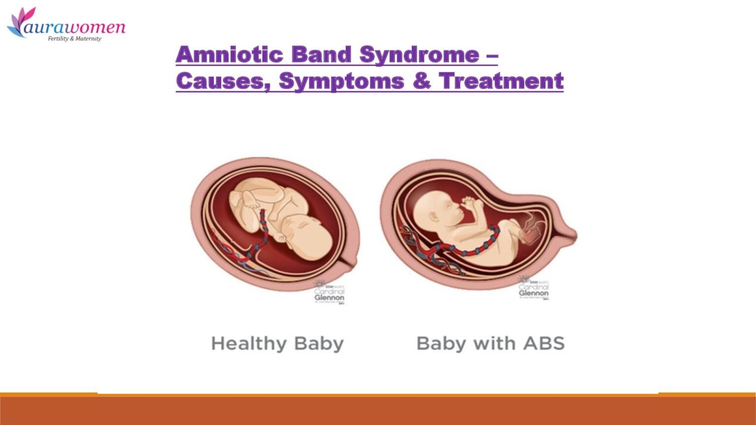 Amniotic Band Syndrome (ABS) – Causes, Symptoms, and Treatment | Aurawomen