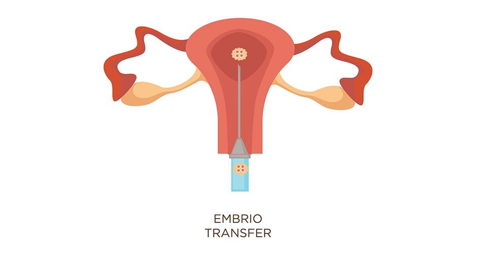 FET – Frozen Embryo Transfer & Impacts | Aurawomen