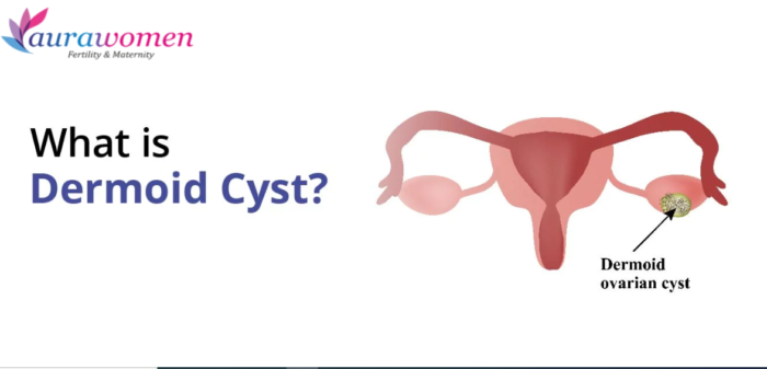 Dermoid Cyst: Complete Information, Symptoms and Treatment | Aurawomen