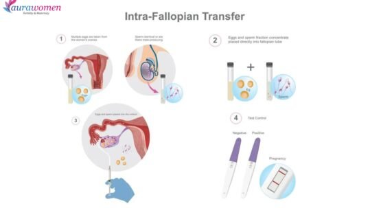 What is Gamete Intrafallopian Transfer (GIFT)? | Aurawomen